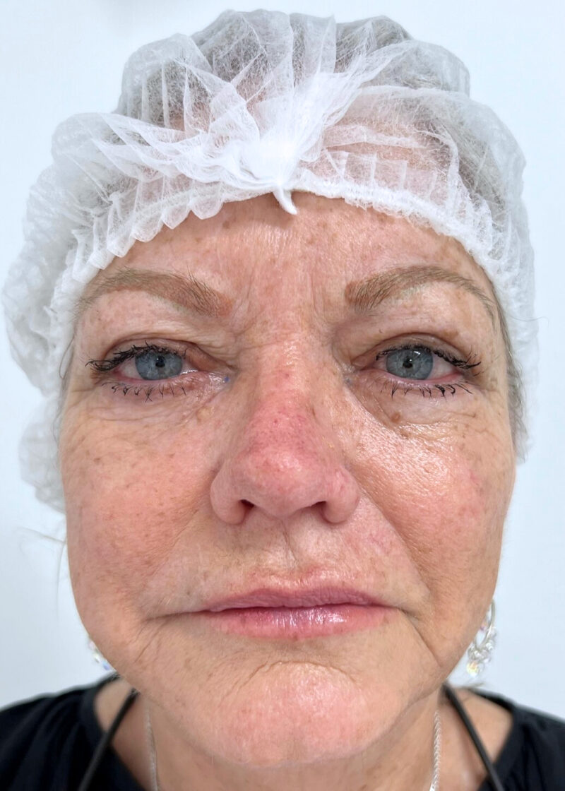 Permanent makeup side effects