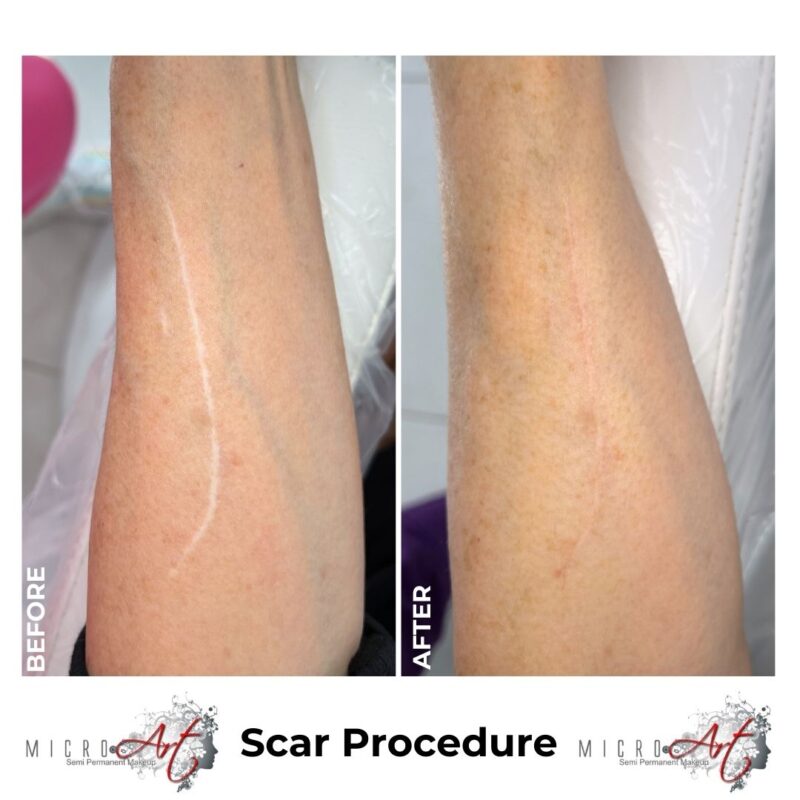 Scar Treatment By MicroArt Semi Permanent Scar Camouflage