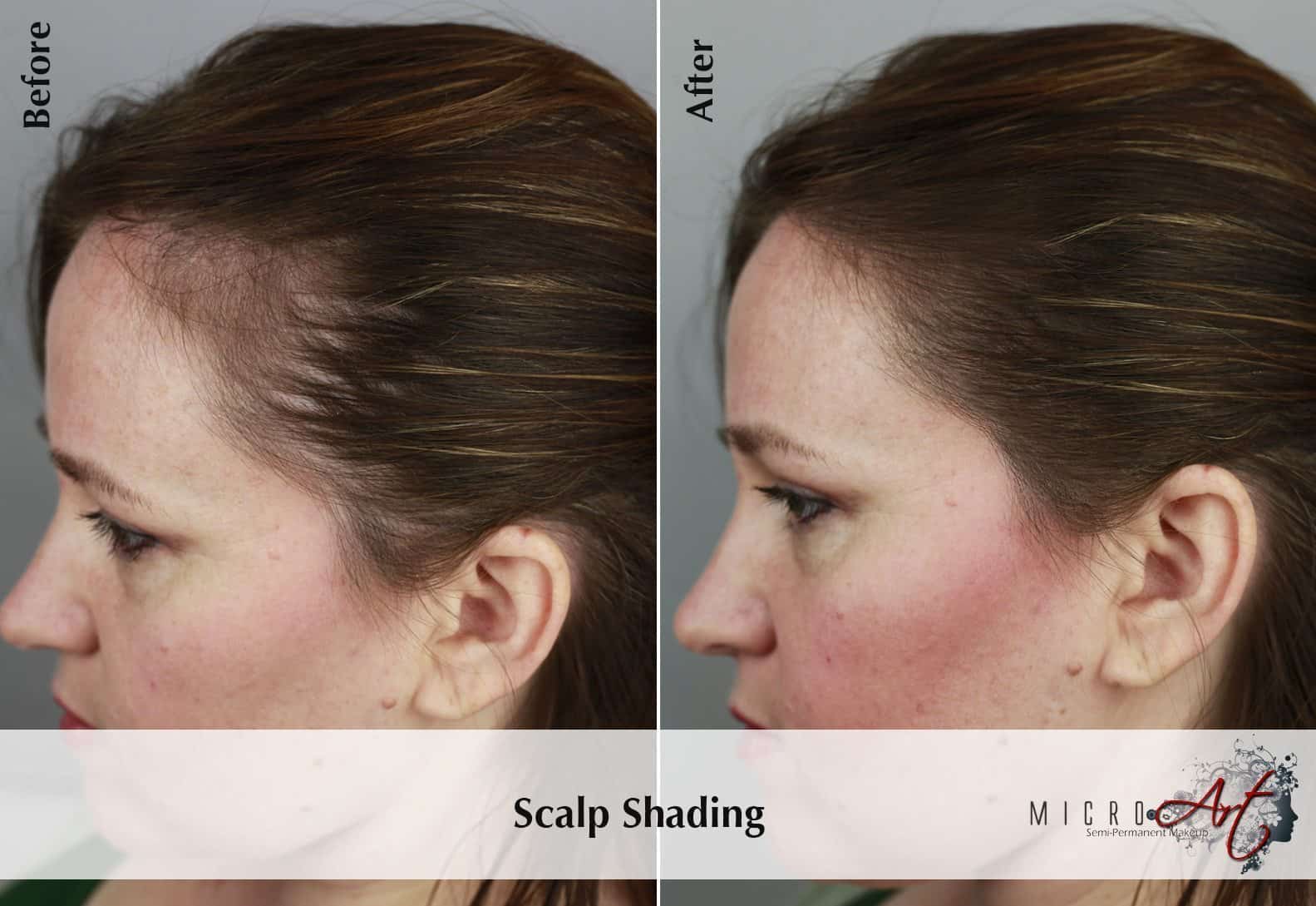 Scalp Shading & SMP Hair Loss Solution Beverly Hills | MicroArt