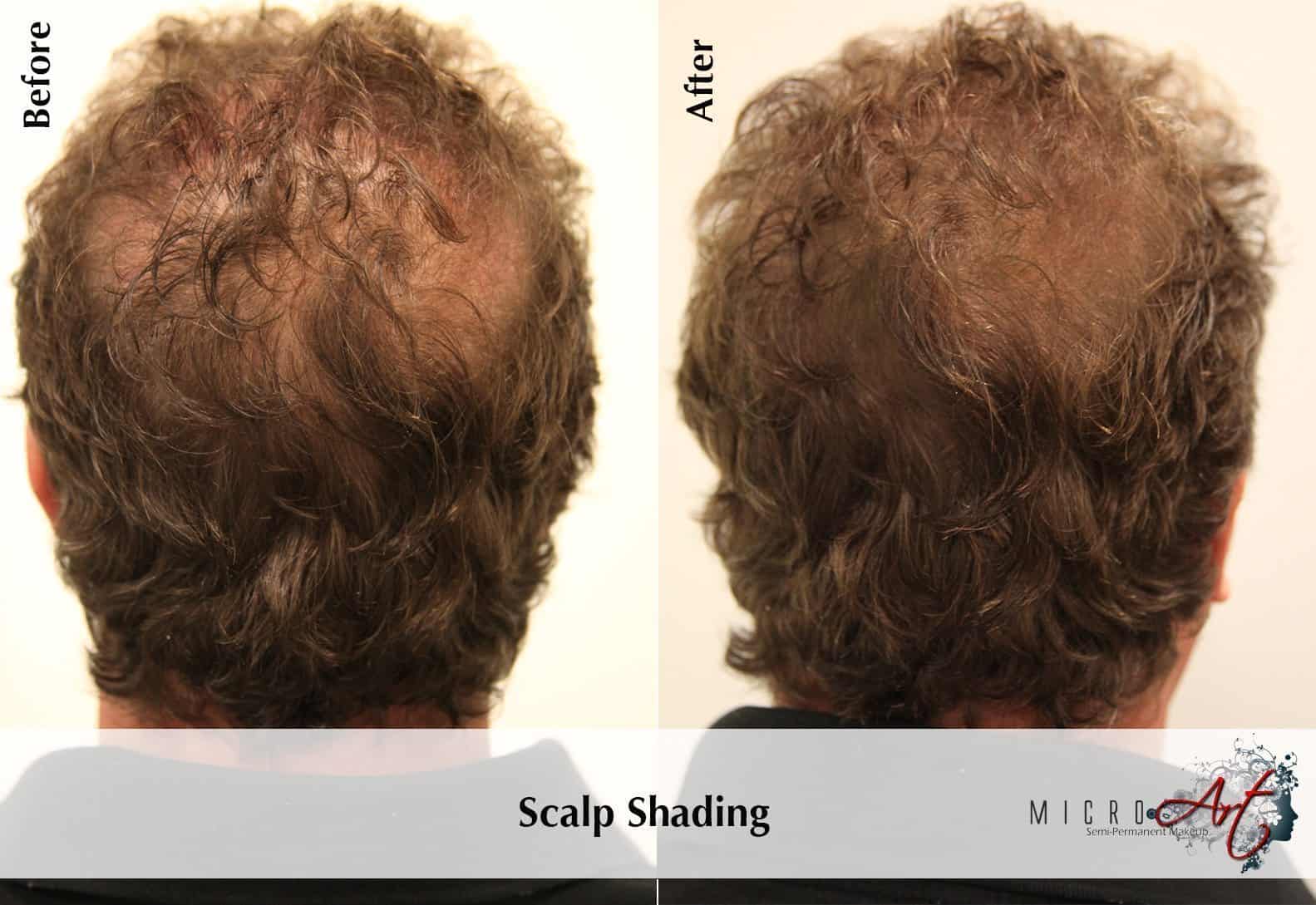 Scalp Shading & SMP Hair Loss Solution Beverly Hills | MicroArt