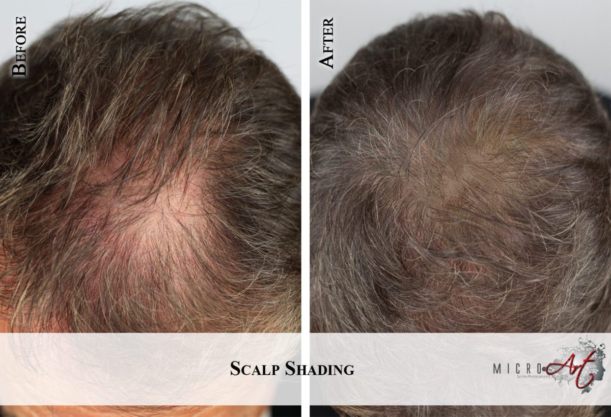 SMP Before and After: Transform Your Thinning Hair Today