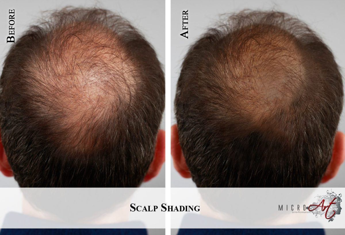 SMP Before and After: Transform Your Thinning Hair Today