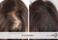 SMP Before and After: Transform Your Thinning Hair Today