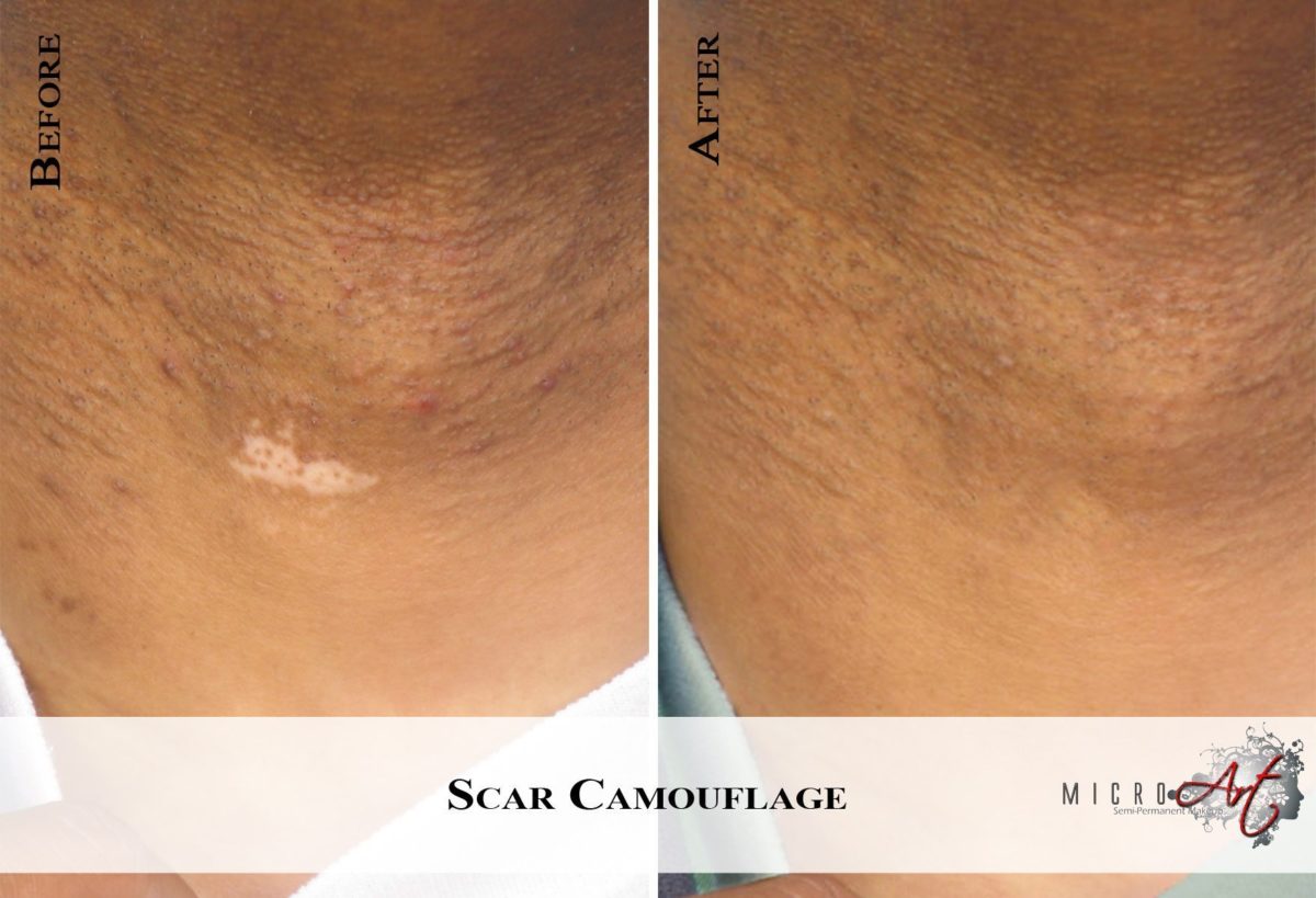 Scar Treatment By MicroArt Semi Permanent Scar Camouflage